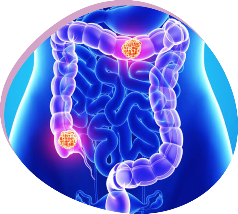 Cancer colonorrectal – Clínica Colorrectal